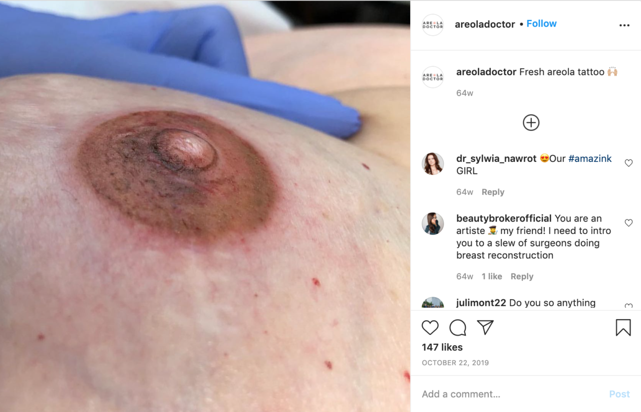3d Nipple Tattoos After Mastectomy Help People Feel Whole 1364