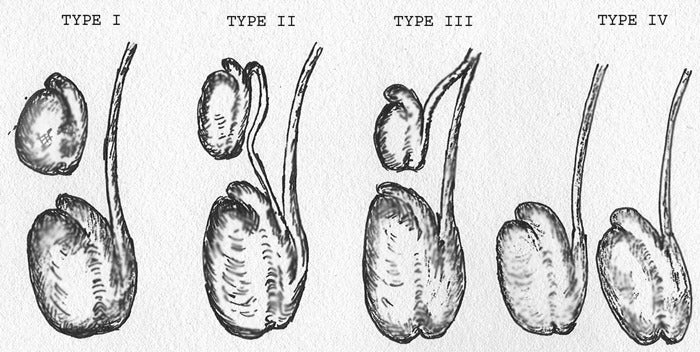 Polyorchidism: What It's Like to Have Three Testicles